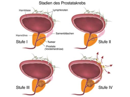 Prostatakrebs | STZ Freiburg - Zentrum für Strahlentherapie